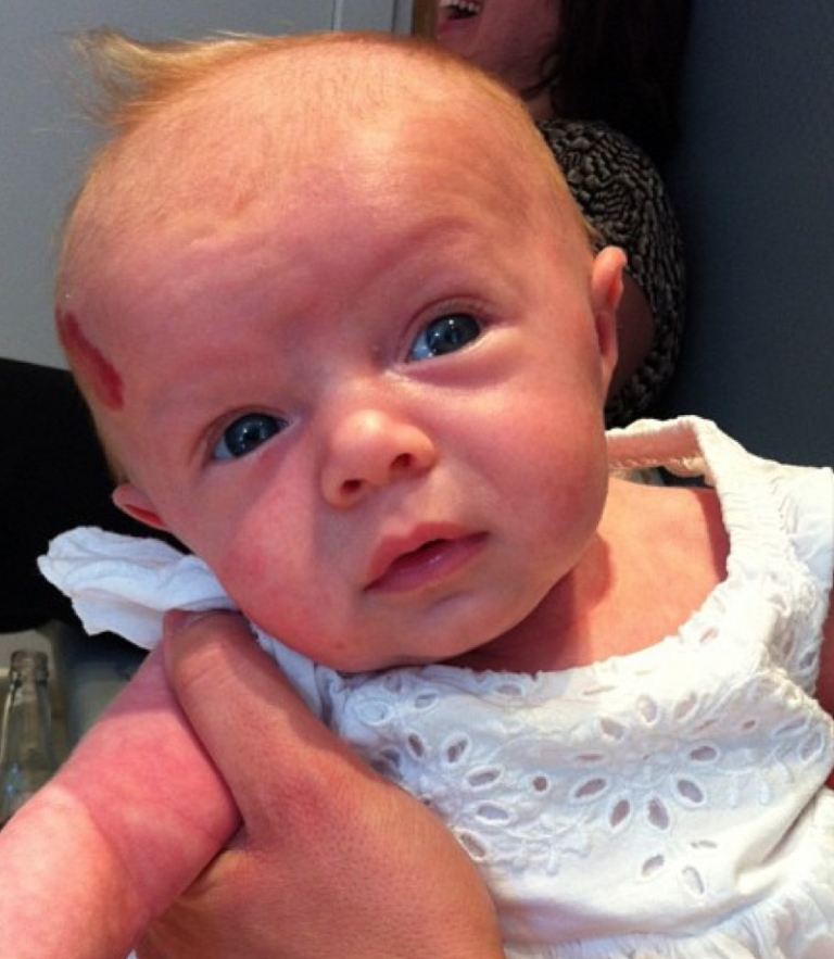 Hemangioma Birthmark on your Child - Stylish Life for Moms